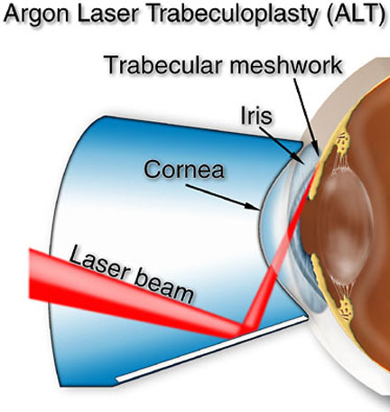 Glaukom – Grüner Star - Augenarztpraxis Büttner Pforzheim